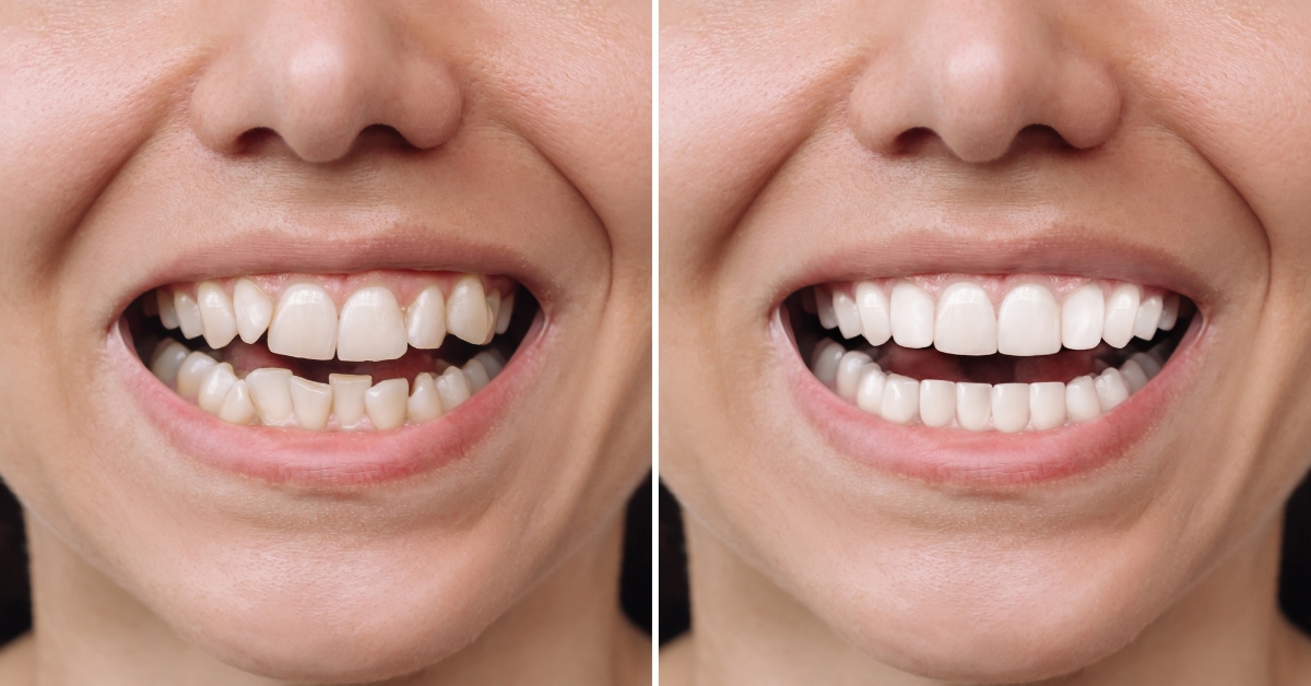 Veneers in Fairbanks AK | Daniel M Bergeron DDS PC | Veneers in 99709